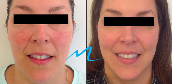 Traitement rosacée-couperose | Clinique MedicoDerma- Dre Lydia Monette