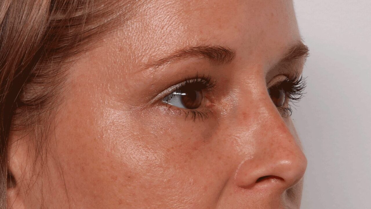 Traitement des cernes | Clinique MedicoDerma- Dre Lydia Monette