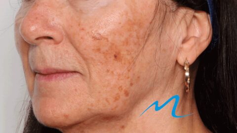 Taches brunes au visage | Clinique MédicoDerma Dr Lydia Monette