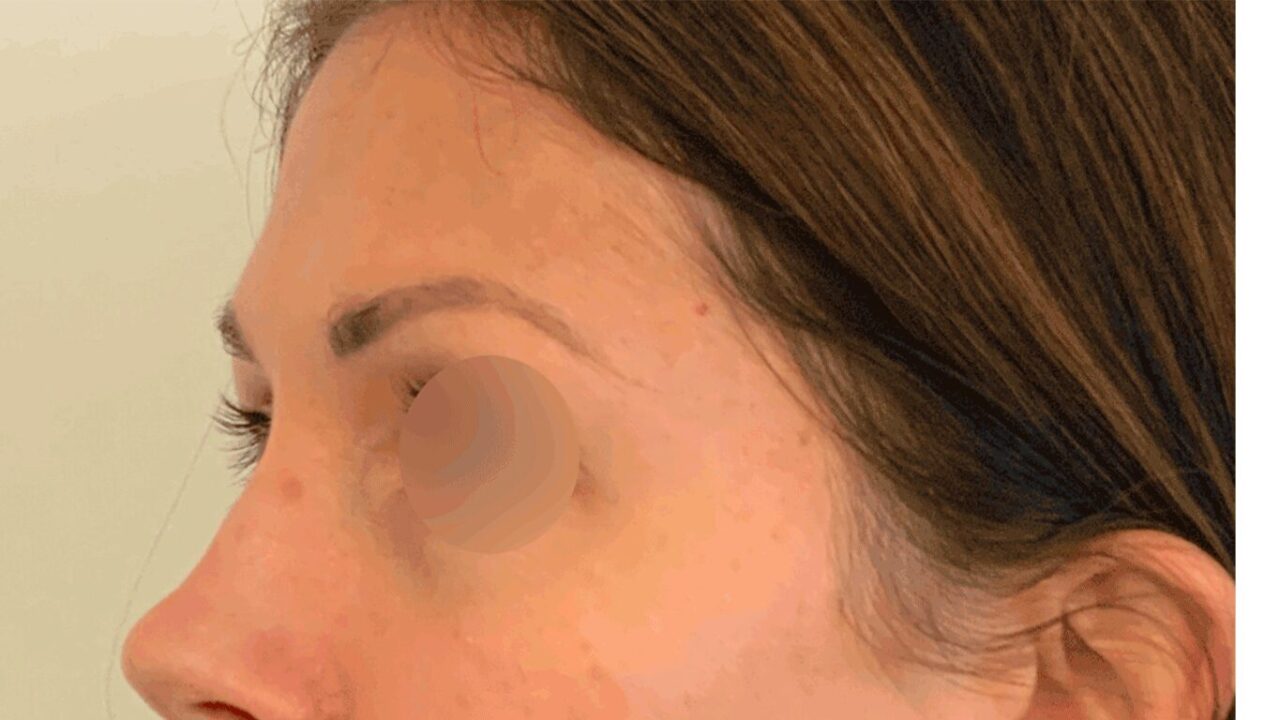 Traitements du melasma | MedicoDerma Dr Lydia Monette