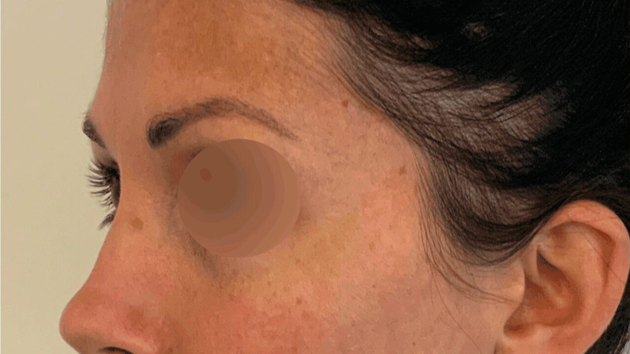 Traitements du melasma | MedicoDerma Dr Lydia Monette