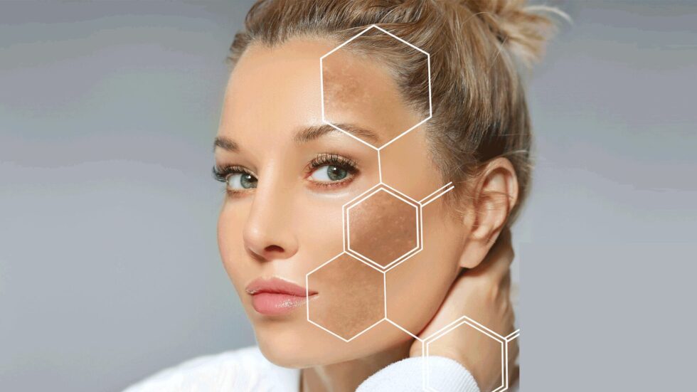 Melasma | Clinique MedicoDerma- Dre Lydia Monette