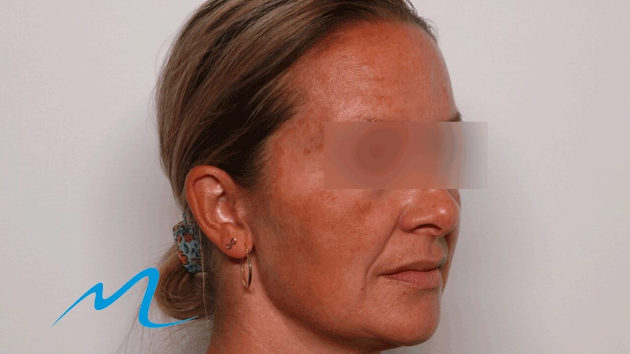 Taches Brunes au visage| MedicoDerma