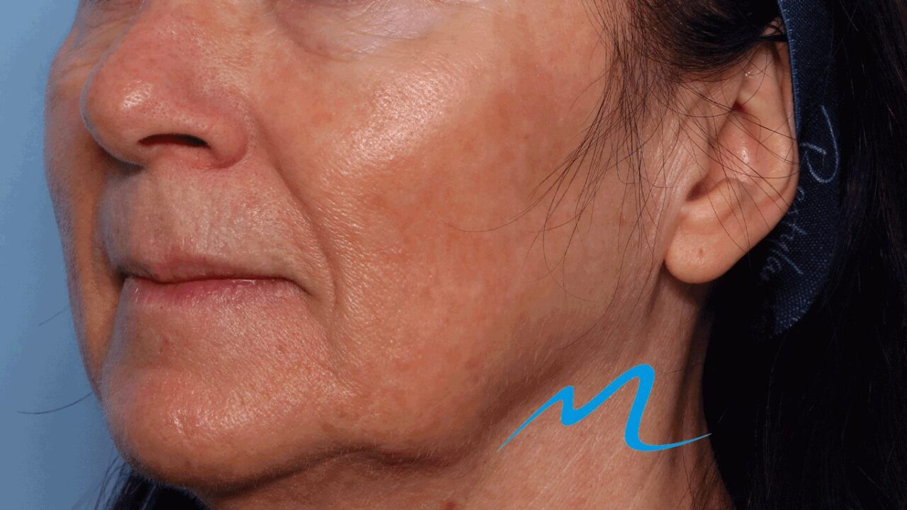 Clinique MedicoDerma- Dre Lydia Monette | Médecine Esthétique